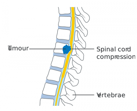 Nerve Compression - Facts & Treatment - Back Pain Treatment