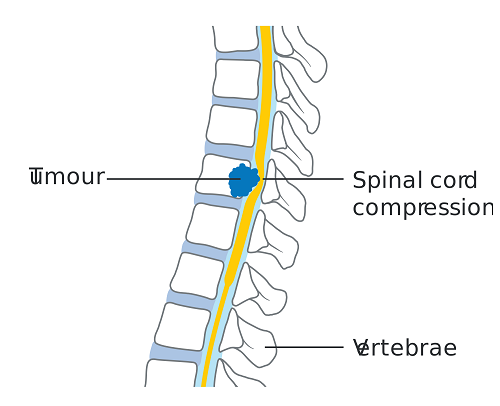 Nerve Compression - Facts & Treatment - Back Pain Treatment